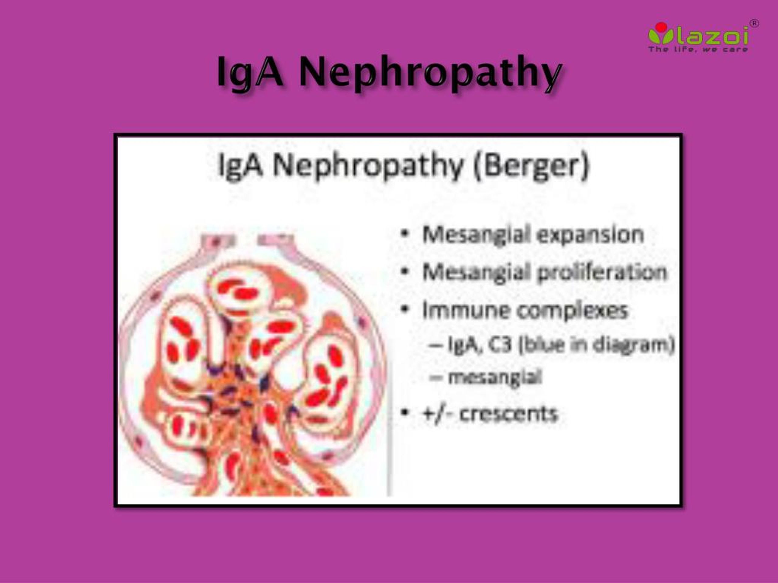 PPT - IgA Nephropathy: Causes, Symptoms, Daignosis, Prevention and ...