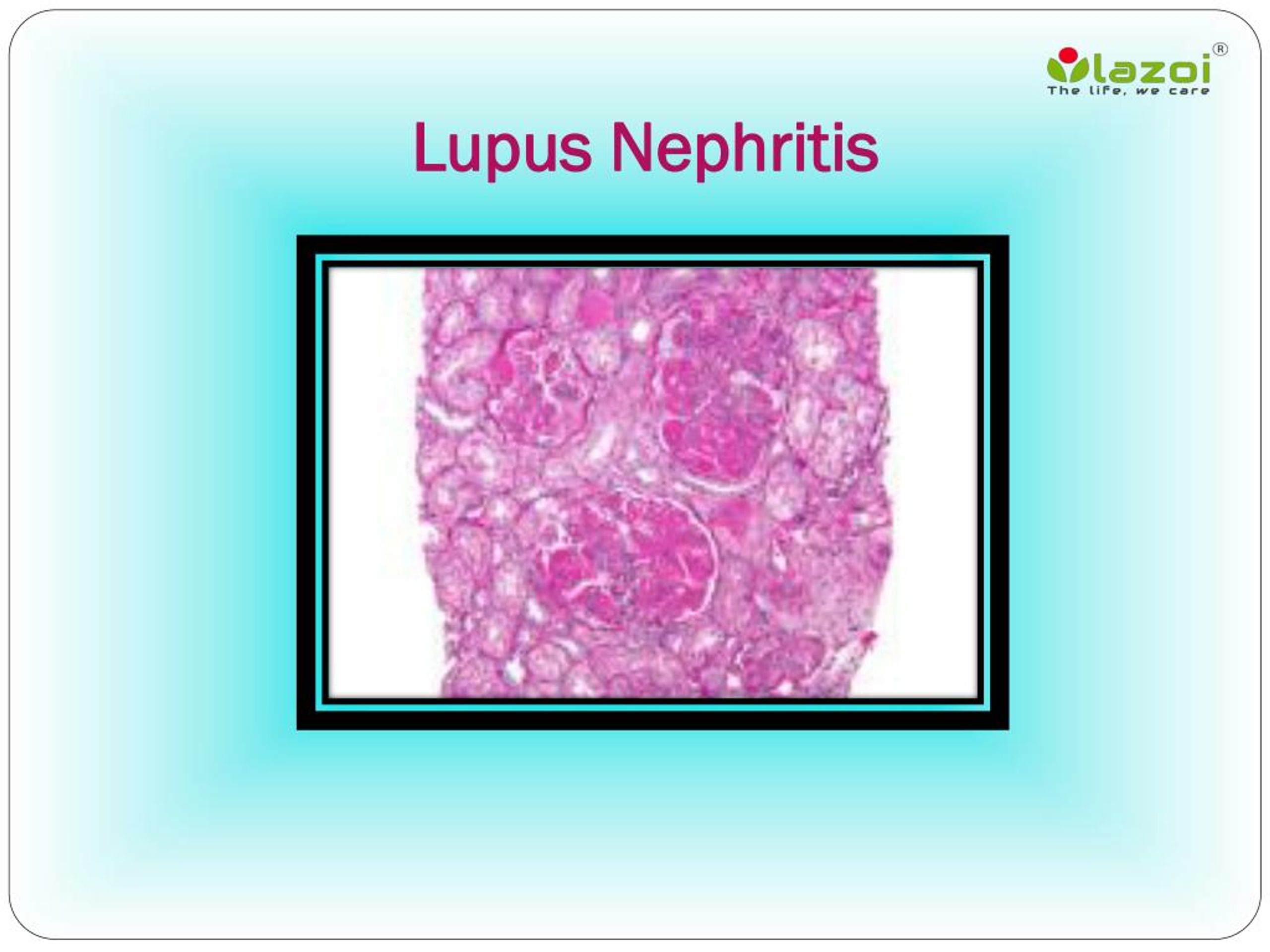 PPT - Lupus Nephritis: Causes, Symptoms, Daignosis, Prevention and ...