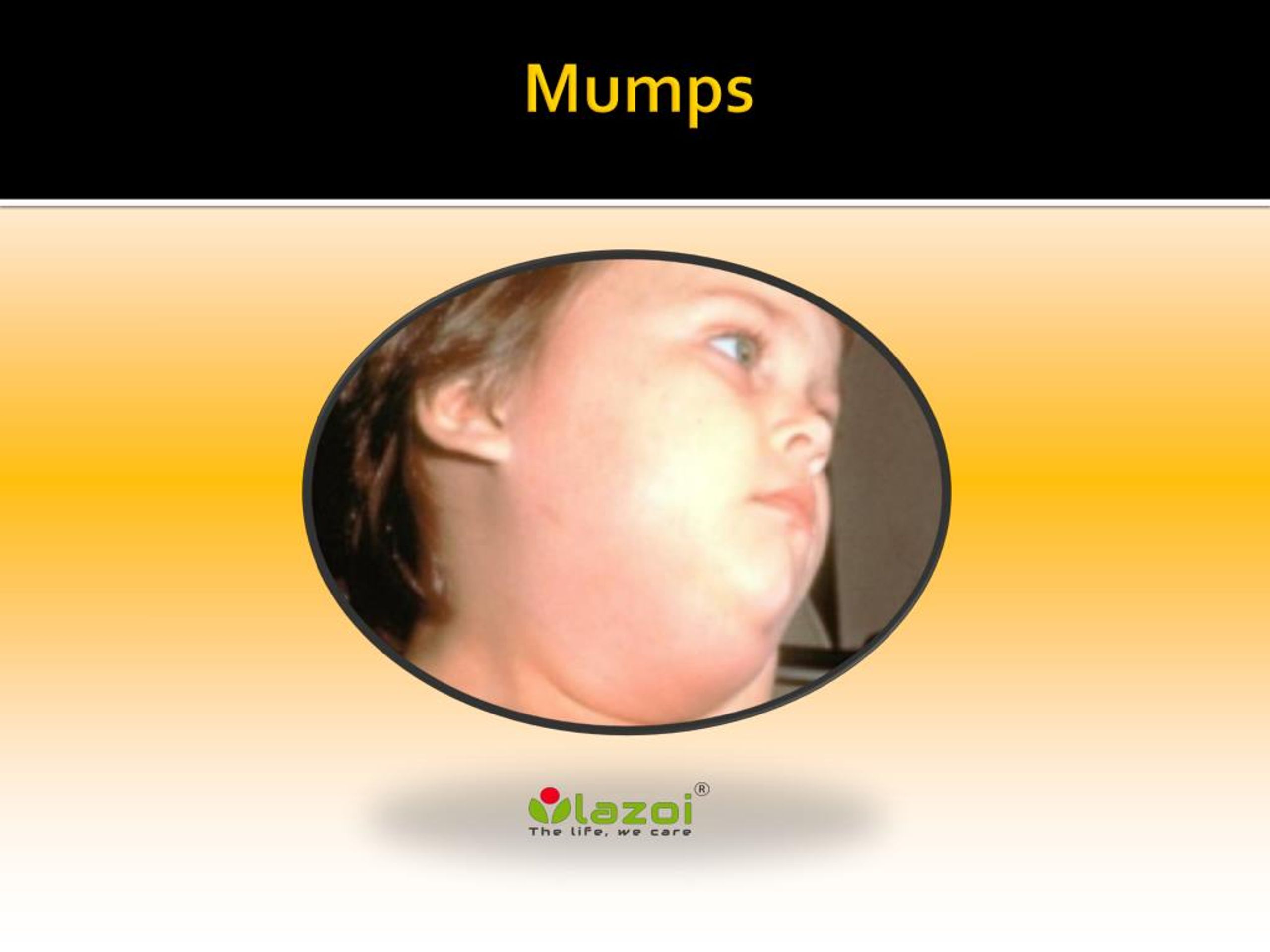 PPT - Mumps: Causes, Symptoms, Daignosis, Prevention and Treatment ...