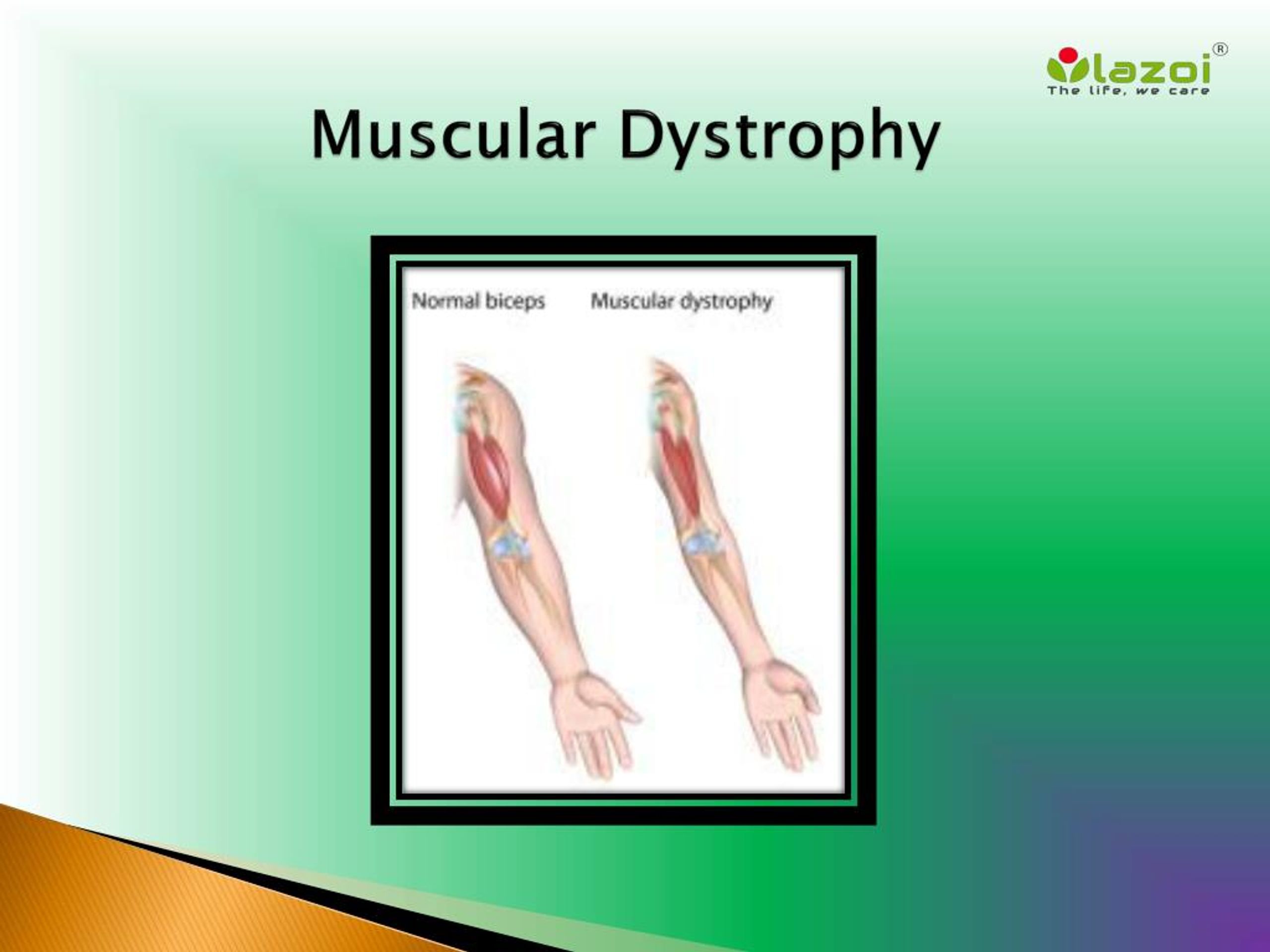 PPT - Muscular Dystrophy: Causes, Symptoms, Daignosis, Prevention and ...