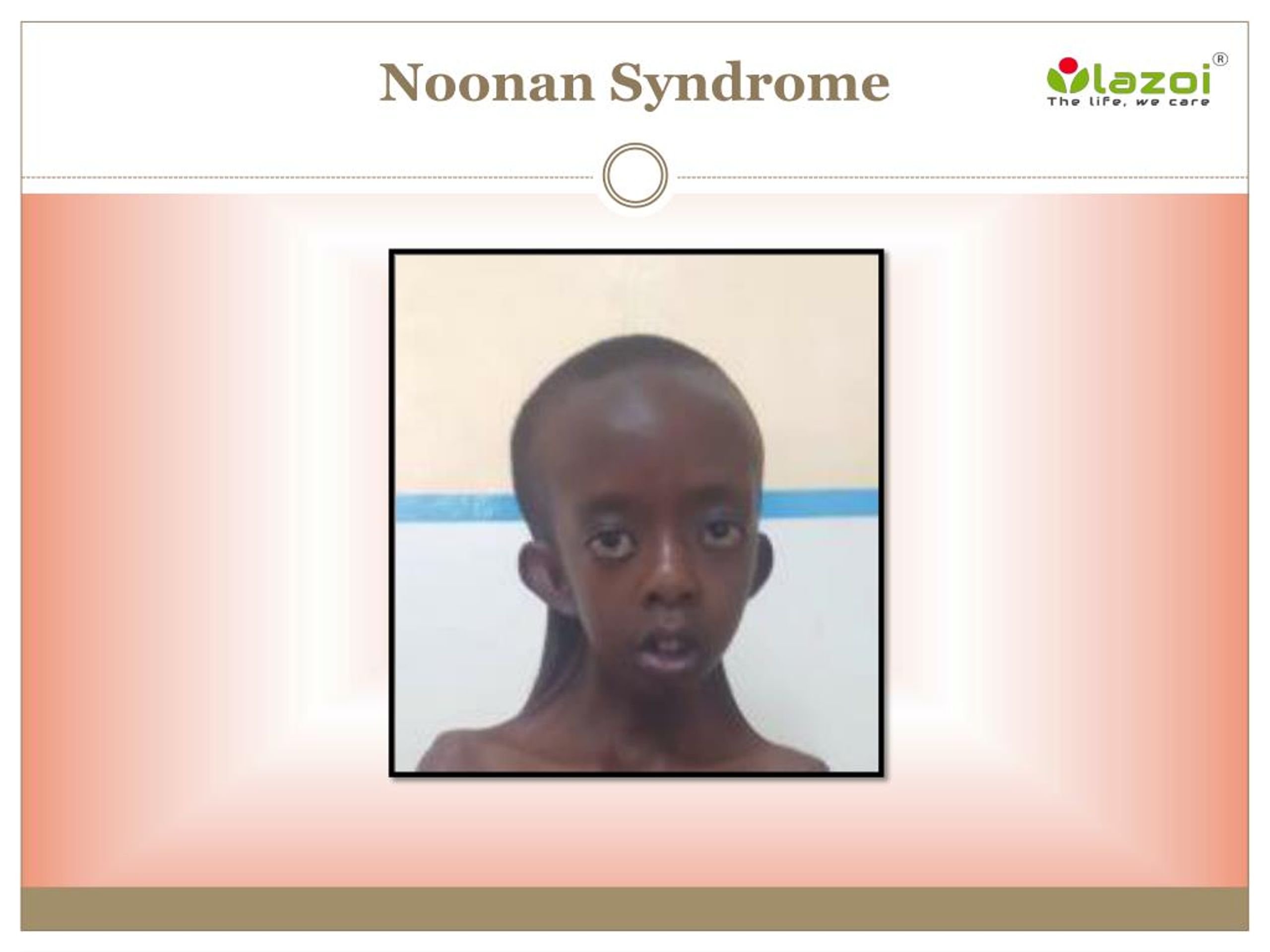PPT - Noonan Syndrome: Causes, Symptoms, Daignosis, Prevention and ...