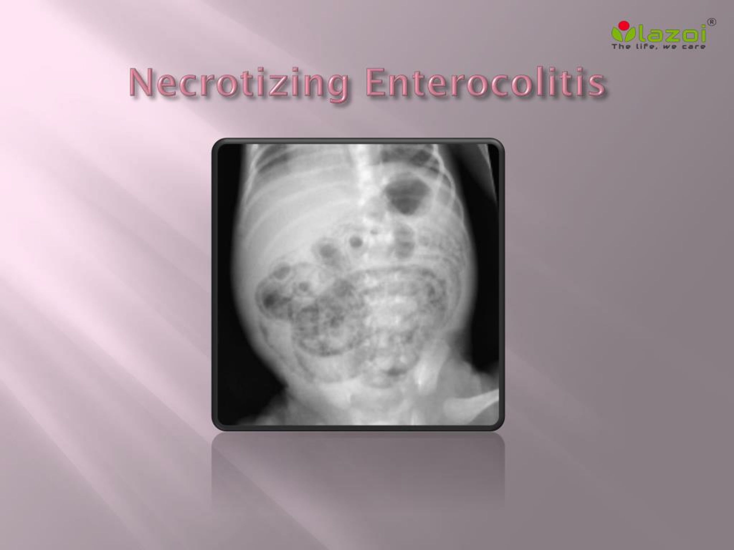 PPT - Necrotizing Enterocolitis: Causes, Symptoms, Daignosis, Prevention and Treatment ...