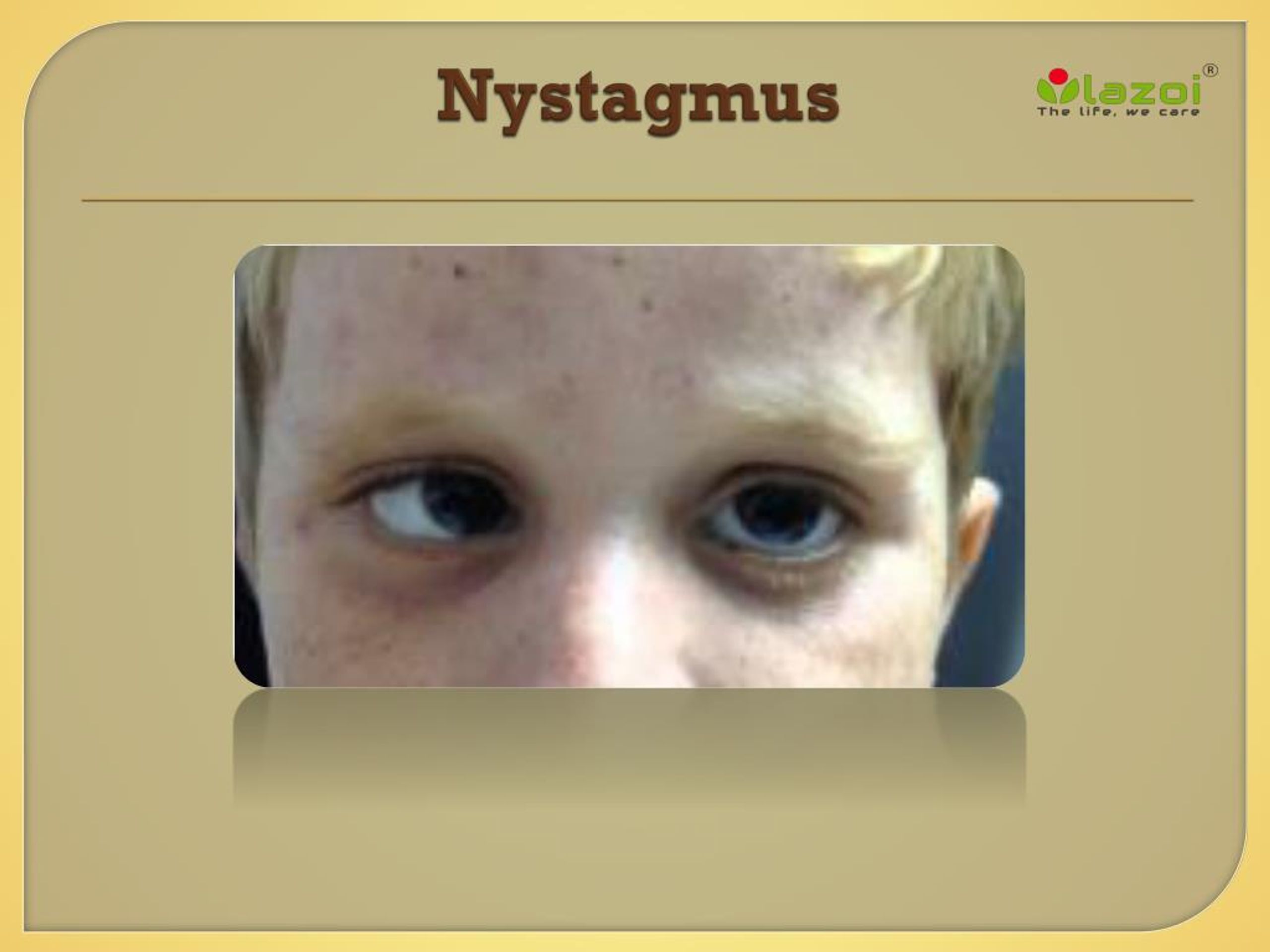 PPT - Nystagmus: Causes, Symptoms, Daignosis, Prevention and Treatment ...