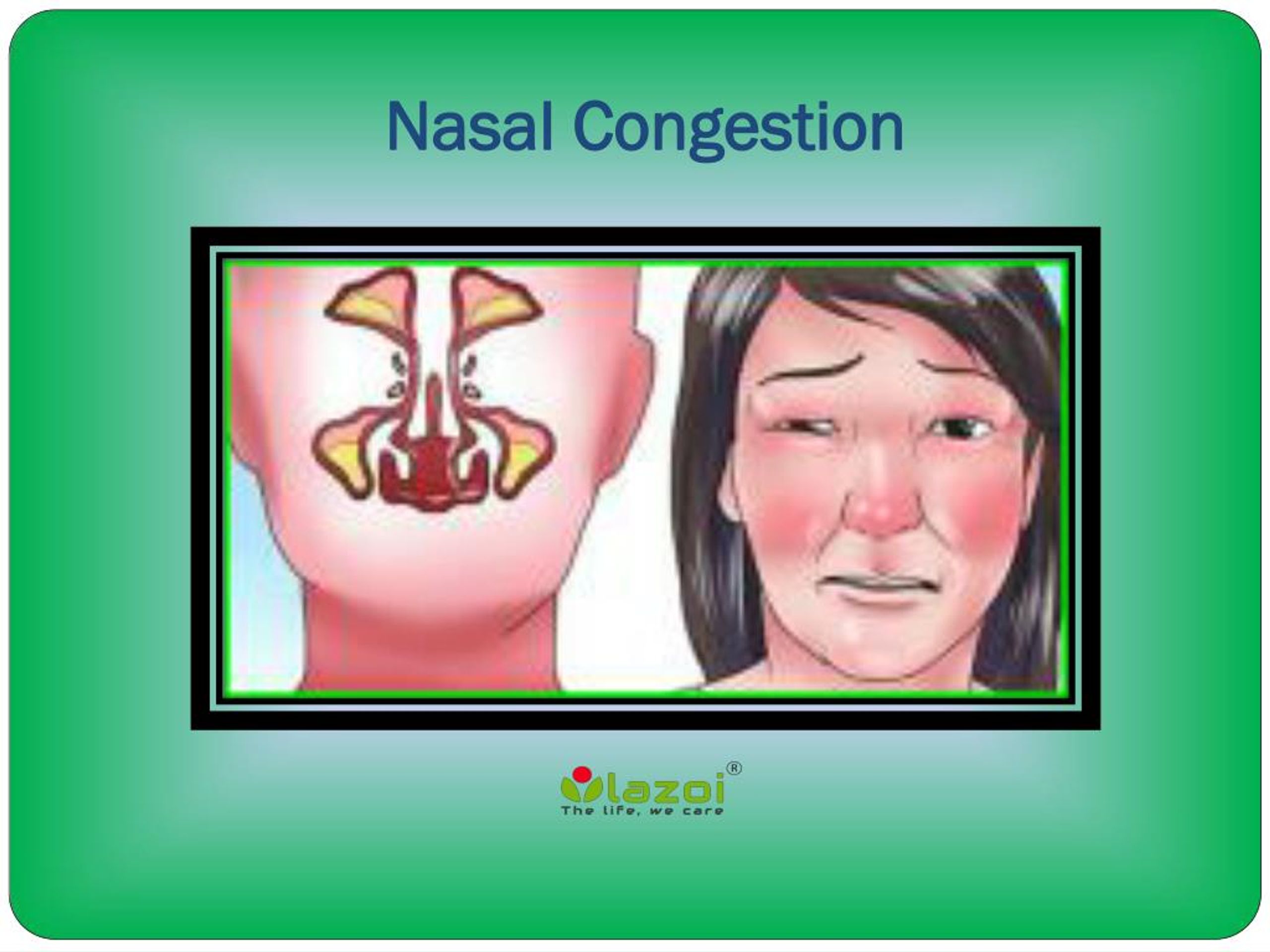 PPT - Nasal Congestion: Causes, Symptoms, Diagnosis and Treatment ...