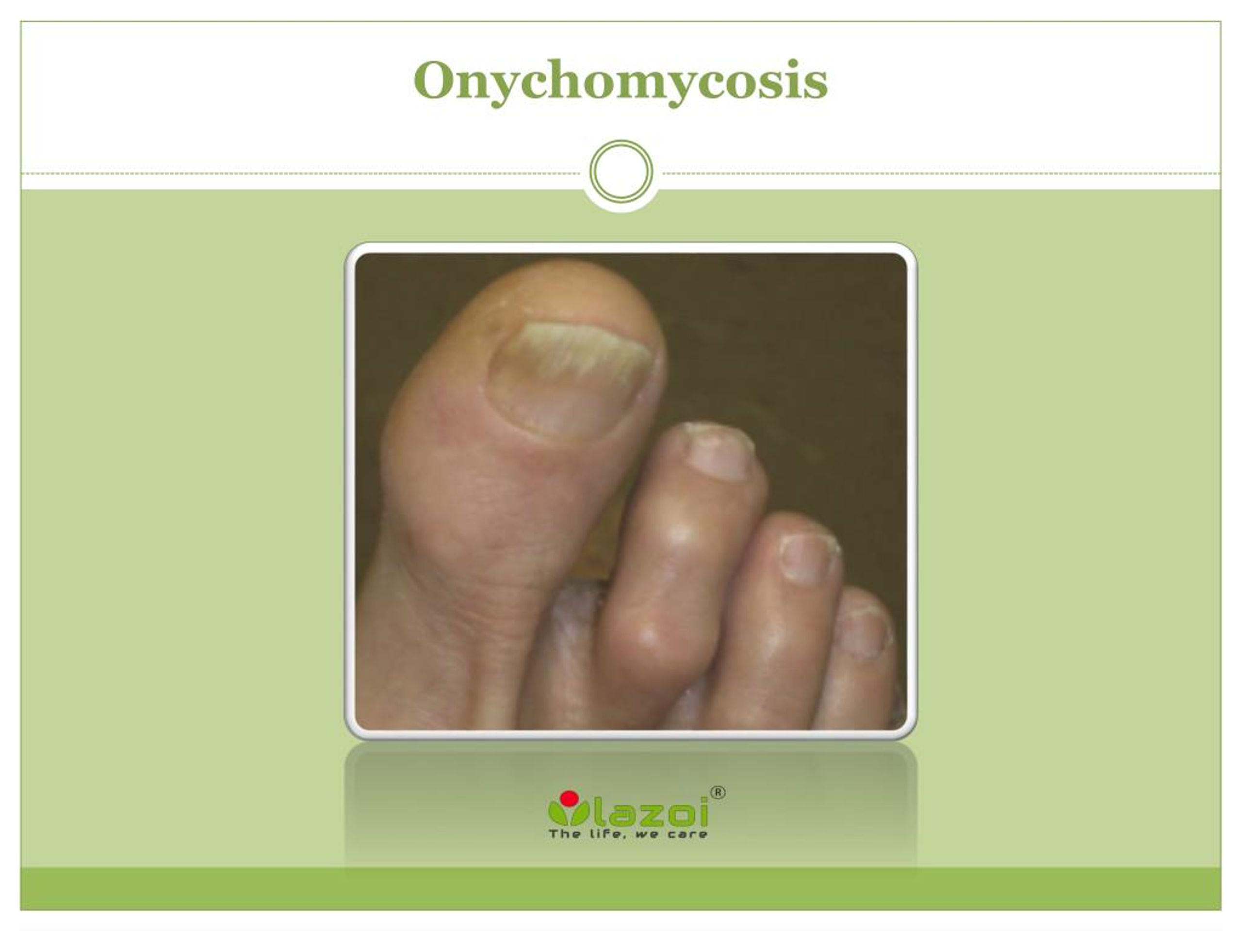 PPT - Onychomycosis: Causes, Symptoms, Daignosis, Prevention and ...
