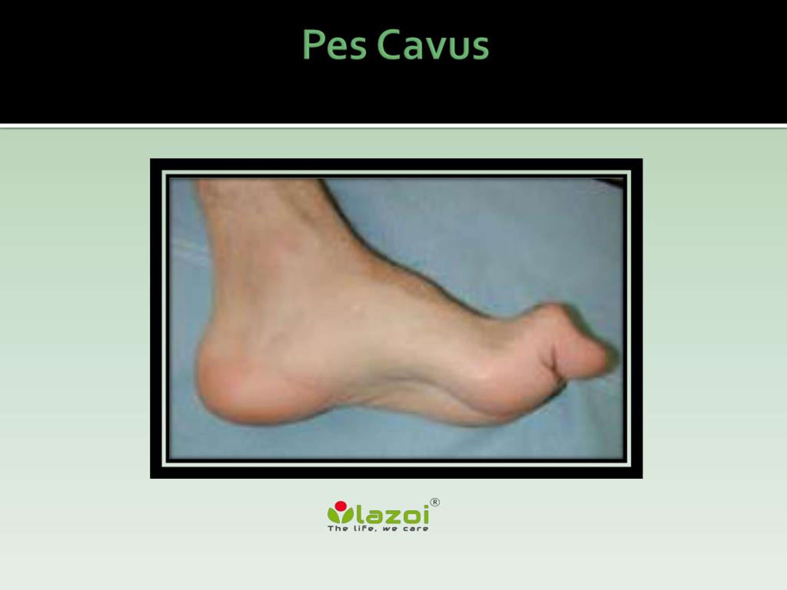 PPT - Pes Cavus: Causes, Symptoms, Daignosis, Prevention and Treatment ...