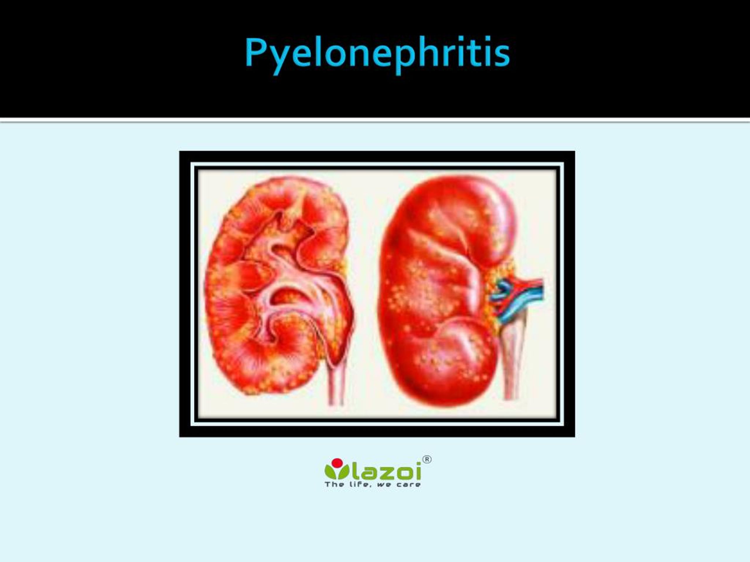 PPT - Pyelonephritis: Causes, Symptoms, Daignosis, Prevention and ...