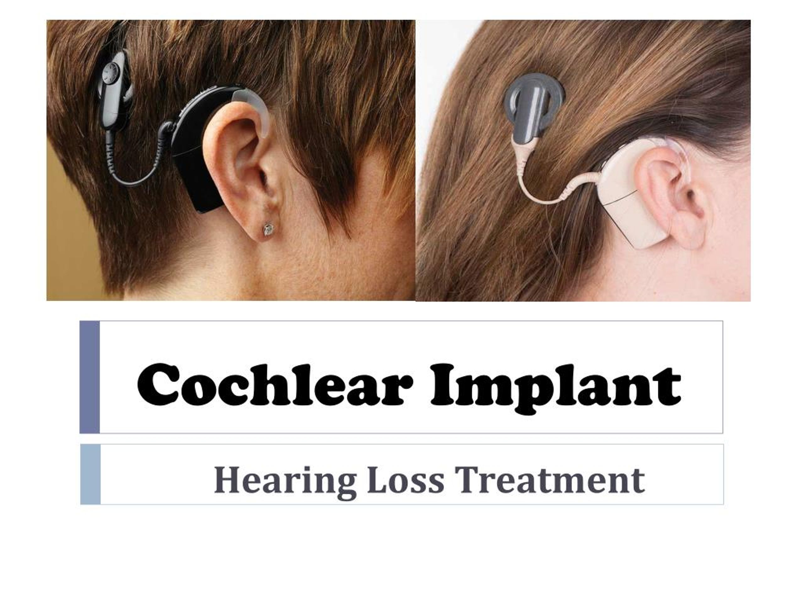 PPT - Cost of cochlear implant in India PowerPoint Presentation, free ...