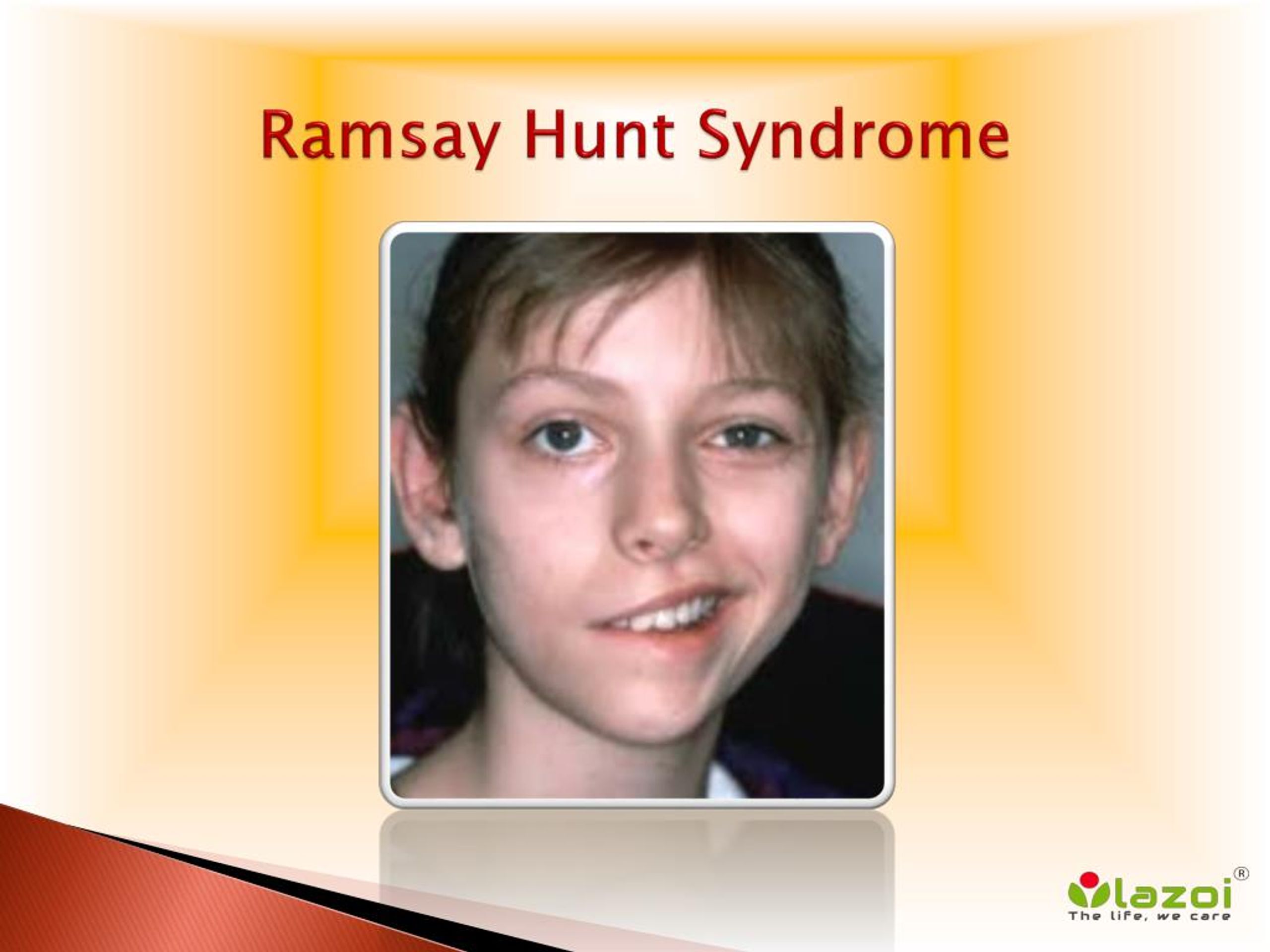 PPT - Ramsay Hunt Syndrome: Causes, Symptoms, Daignosis, Prevention and ...