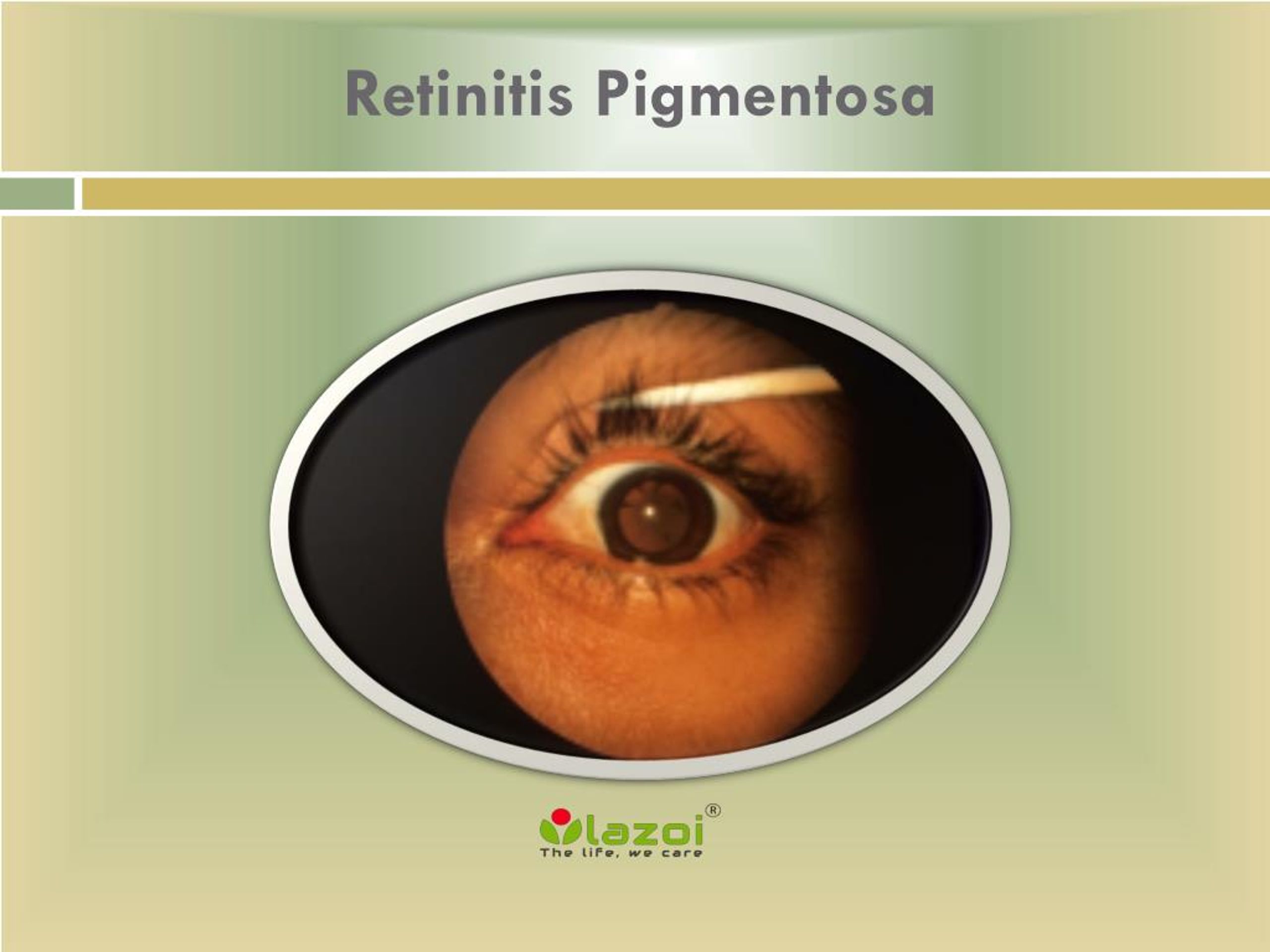 PPT - Retinitis Pigmentosa: Causes, Symptoms, Daignosis, Prevention and ...