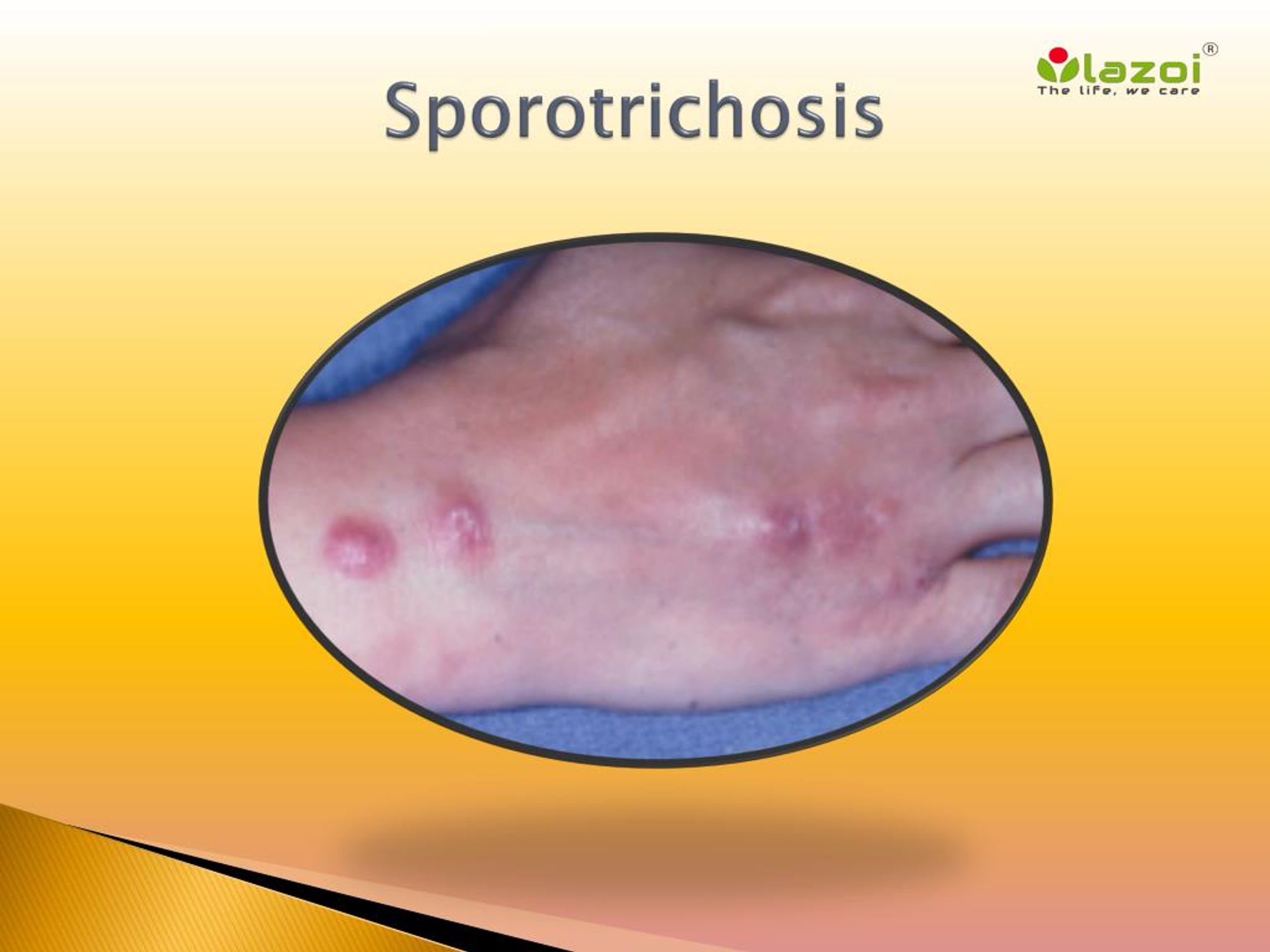 PPT - Sporotrichosis: Causes, Symptoms, Daignosis, Prevention and ...