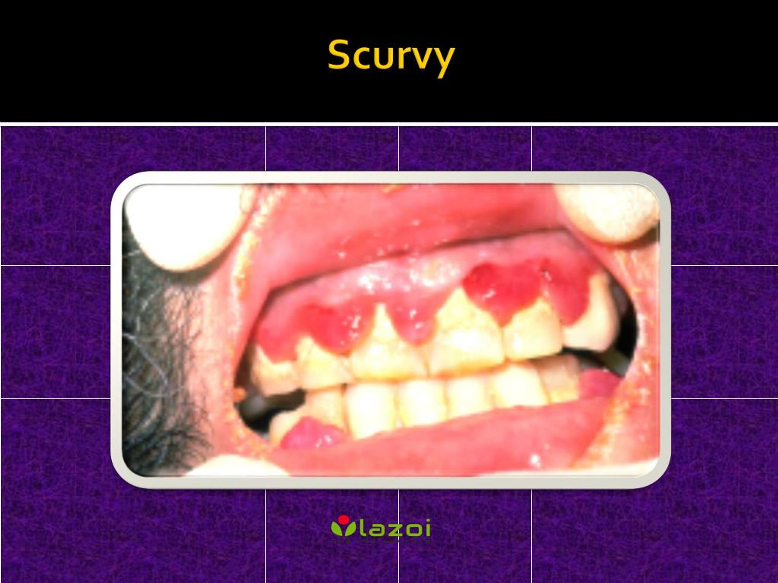 PPT - Scurvy: Causes, Symptoms, Daignosis, Prevention and Treatment ...