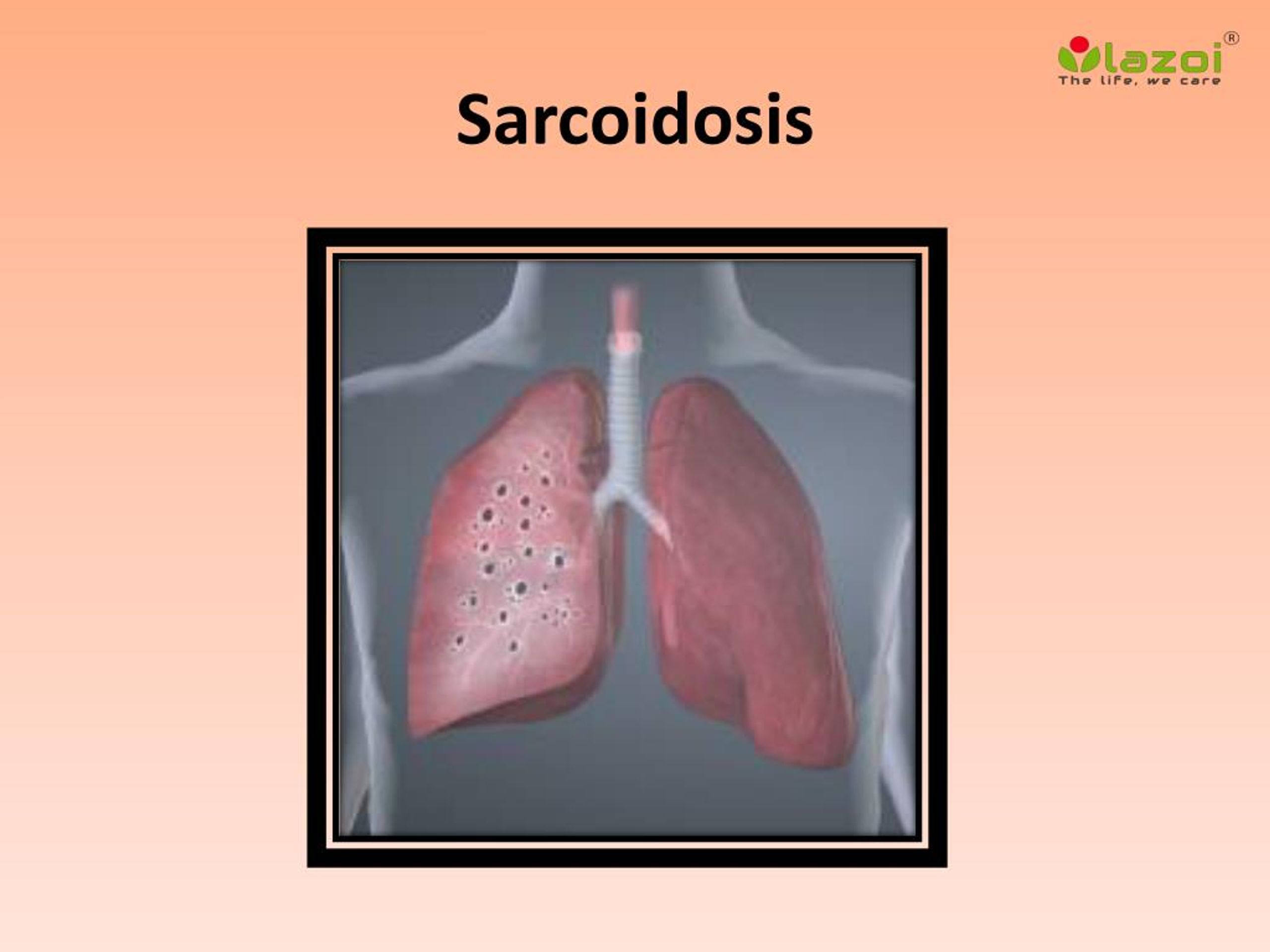 PPT - Sarcoidosis: Causes, Symptoms, Daignosis, Prevention and ...