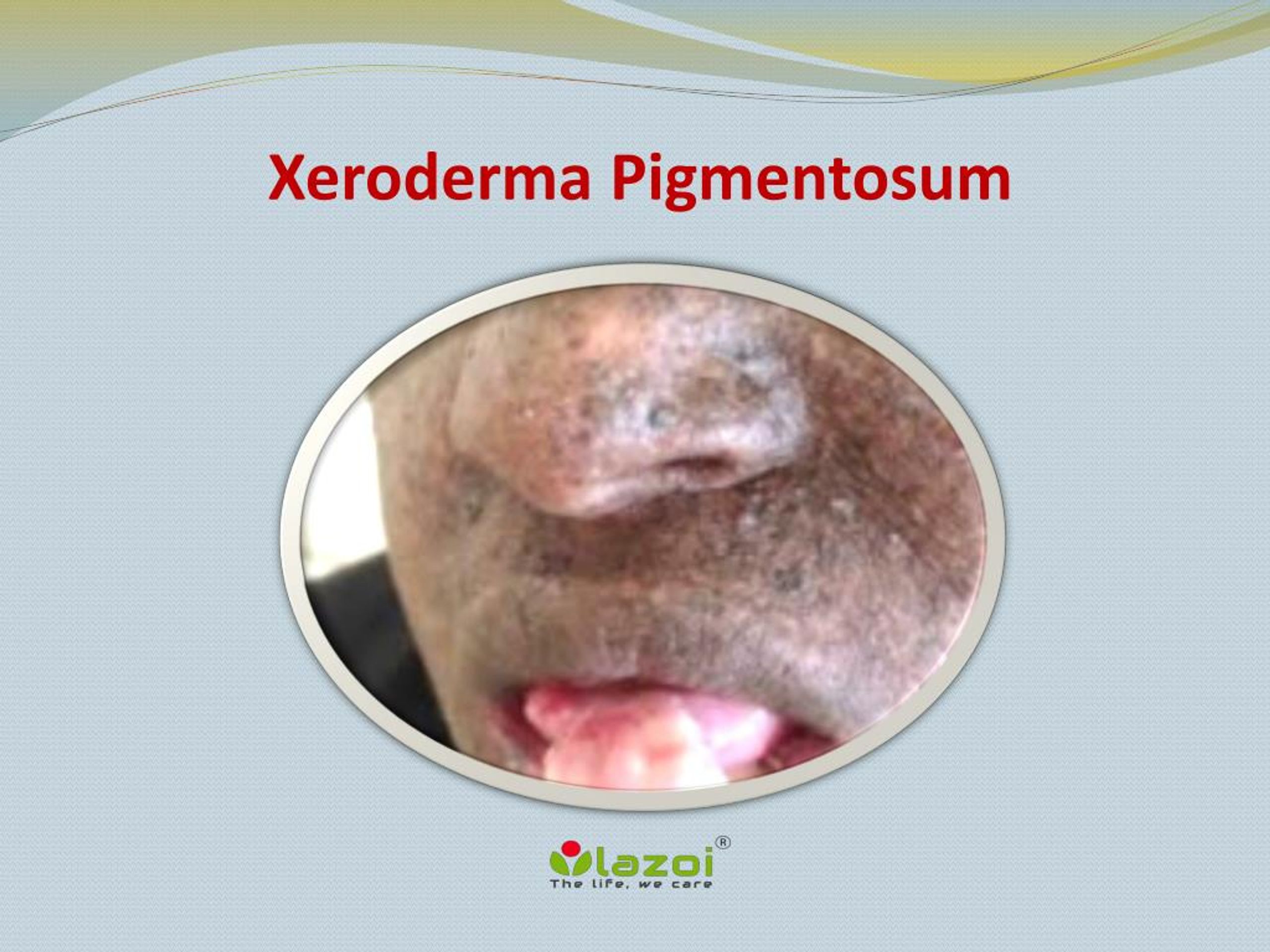 PPT - Xeroderma Pigmentosum: Causes, Symptoms, Daignosis, Prevention ...
