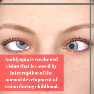 PPT - Dichoptic therapy for Amblyopia or lazy eye PowerPoint ...