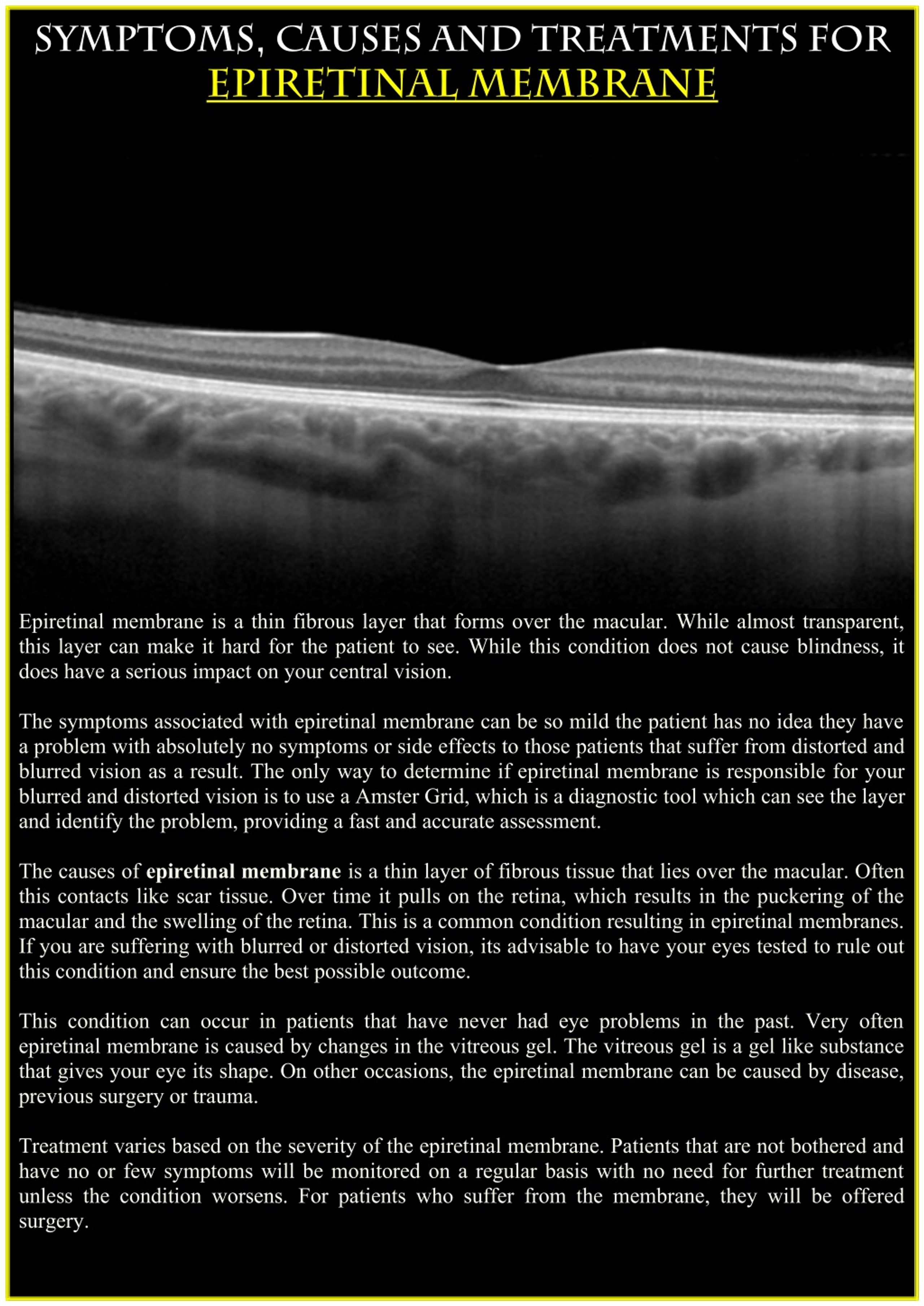 PPT - Symptoms,Causes and Treatments for Epiretinal Membrane PowerPoint Presentation - ID:8488770