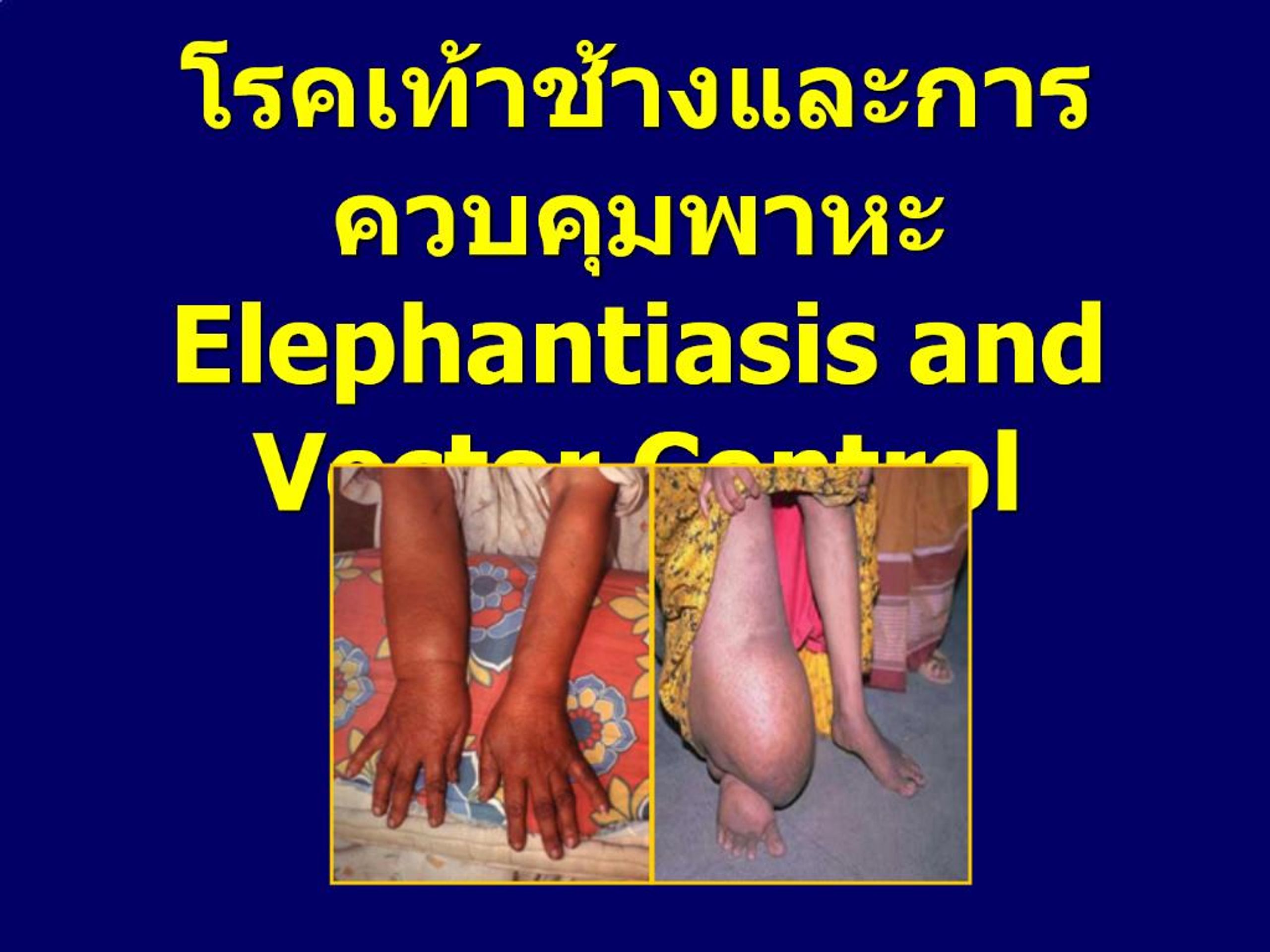 PPT - Elephantiasis and Vector Control PowerPoint Presentation, free download - ID:944879